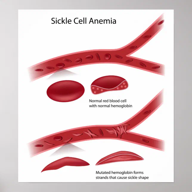 Sickle cell disease Poster | Zazzle
