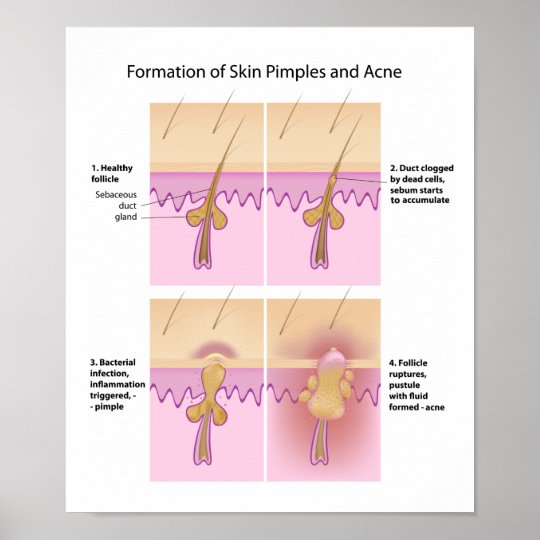 Skin Acne and pimples Poster | Zazzle.com