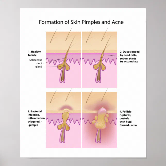 Skin Acne and pimples Poster | Zazzle