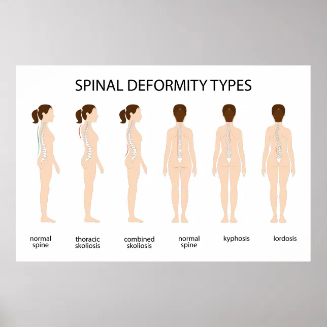 Spinal deformity types poster | Zazzle