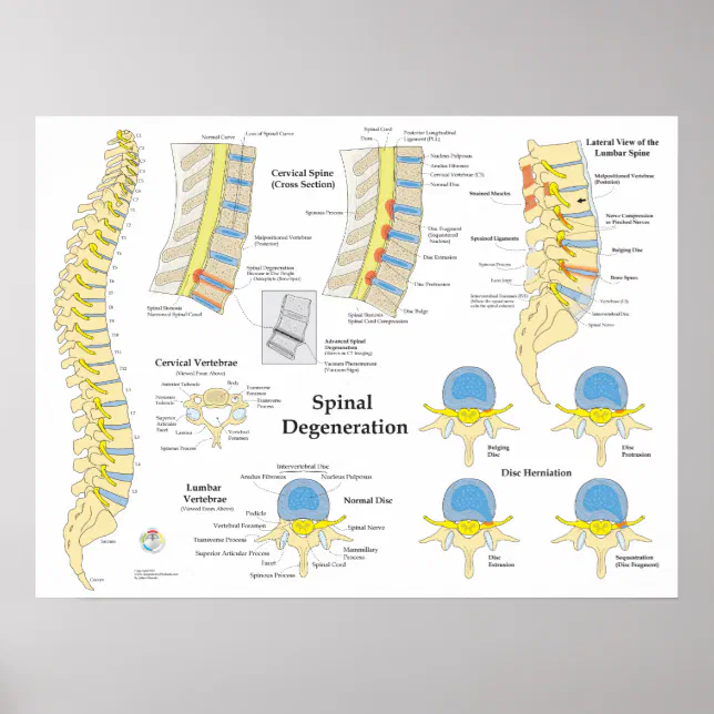 Spinal Degeneration Disc Herniation Poster | Zazzle
