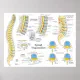Spinal Degeneration Disc Herniation Poster | Zazzle
