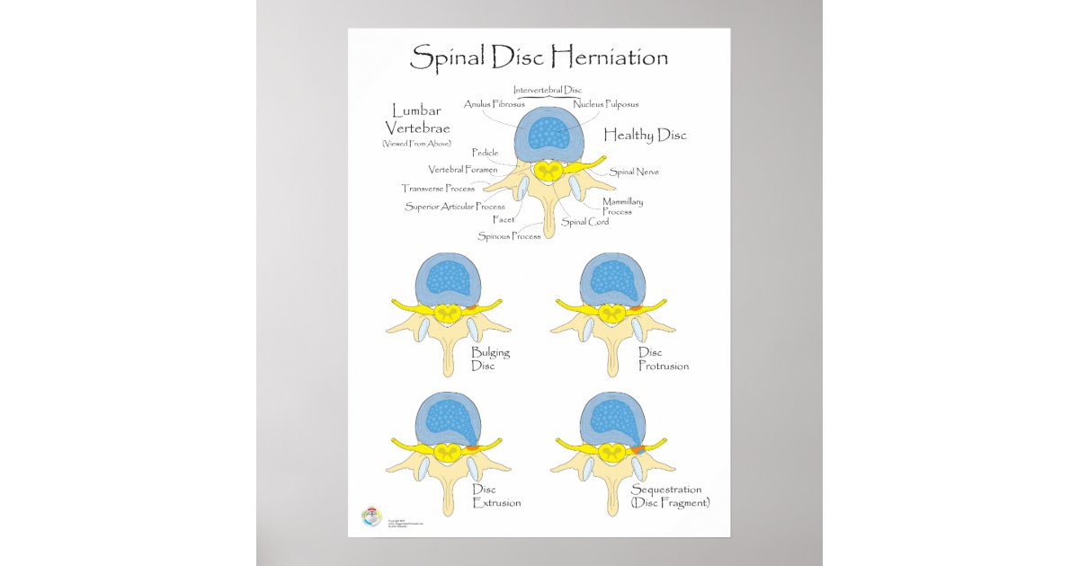 Spinal Disc Herniation Poster Medical Poster | Zazzle