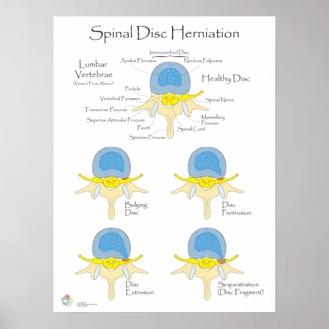 Spinal Disc Herniation Poster Medical Poster | Zazzle