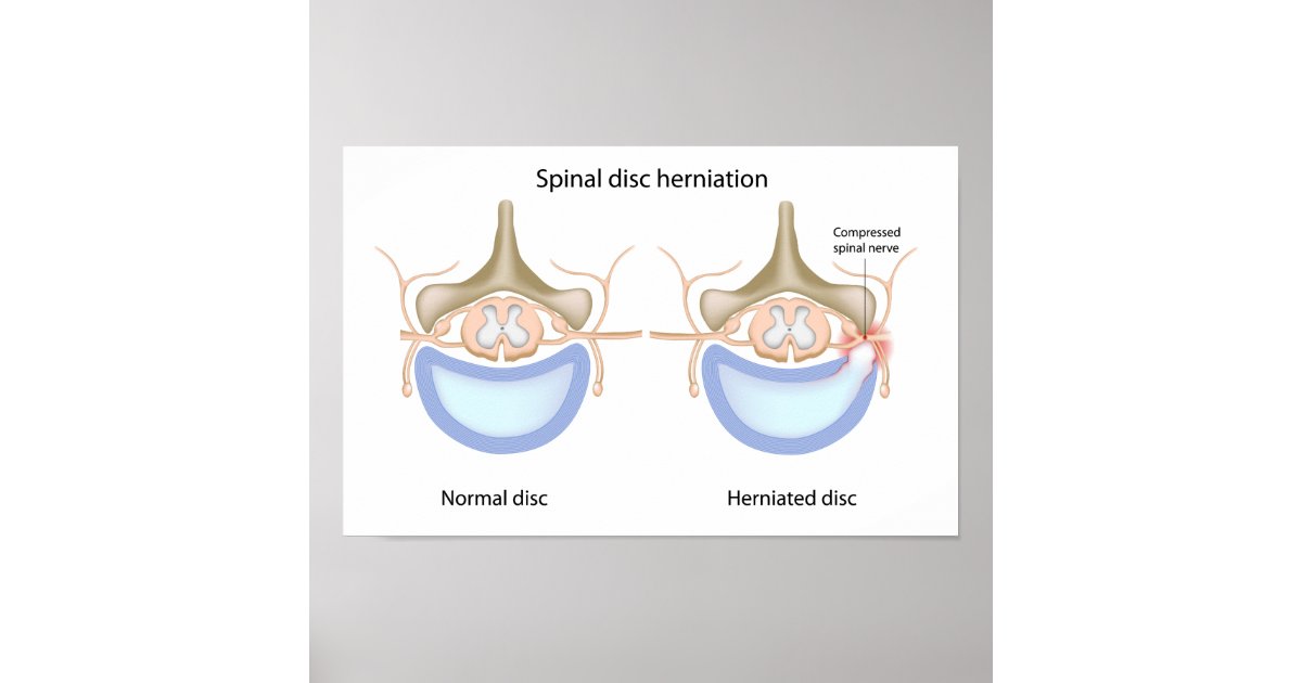 Spinal disk herniation Poster | Zazzle