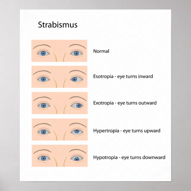 Strabismus eye defect Poster | Zazzle