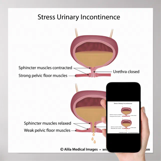 Stress urinary incontinence in women. poster | Zazzle
