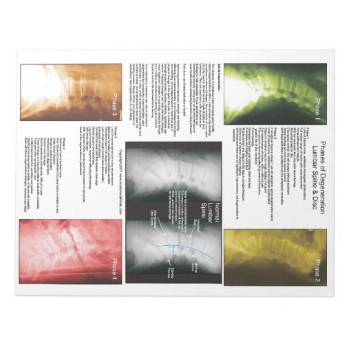 Tear Off Pad Lumbar Spinal Degeneration | Zazzle