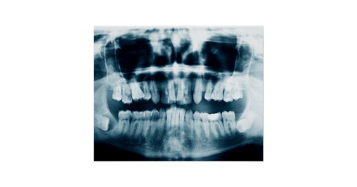 Teeth X-ray Poster | Zazzle