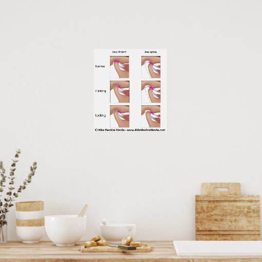 Temporomandibular joint dysfunction, TMJ or TMD Poster | Zazzle