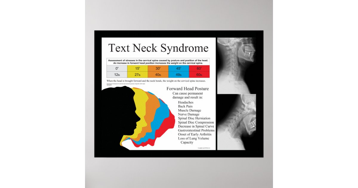 Text Neck Syndrome Chiropractic Poster | Zazzle