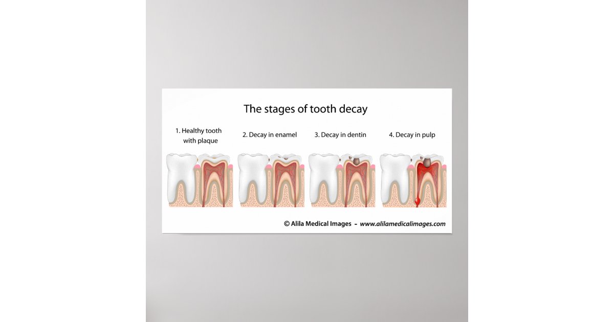 Tooth decay Poster | Zazzle