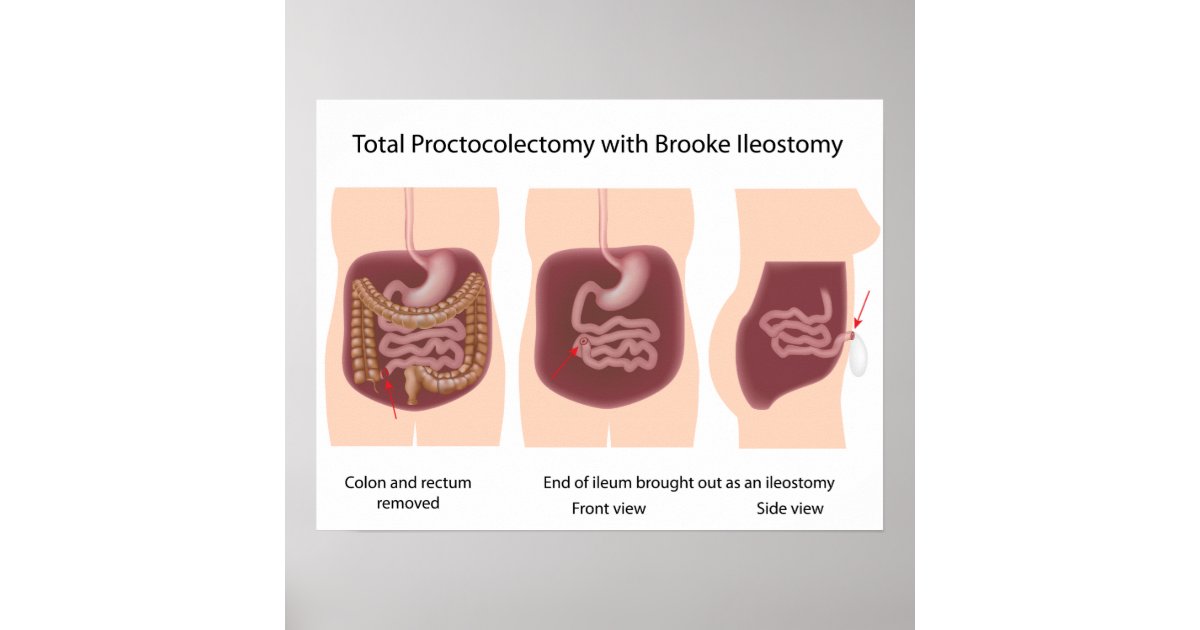 Total proctocolectomy with Brooke ileostomy poster | Zazzle