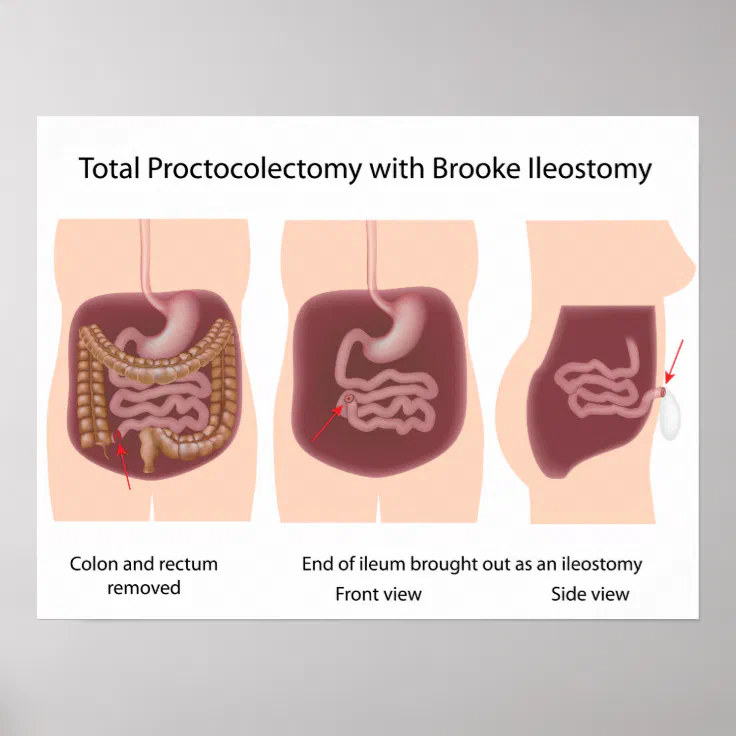 Total proctocolectomy with Brooke ileostomy poster | Zazzle