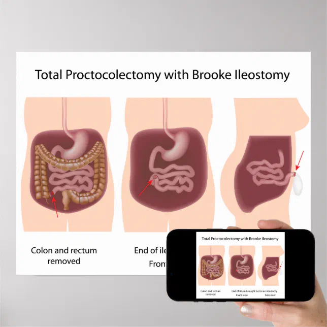 Total proctocolectomy with Brooke ileostomy poster | Zazzle