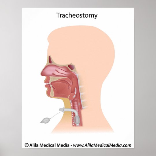 Tracheostomy drawing. poster | Zazzle.com