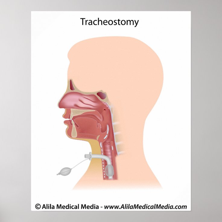Tracheostomy drawing. poster | Zazzle