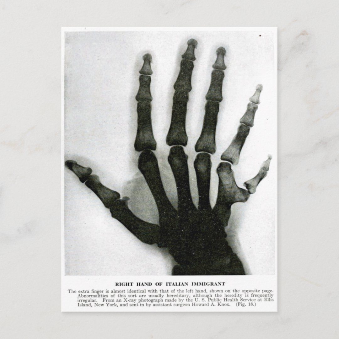 X-Ray Hand with Extra Finger Postcard | Zazzle